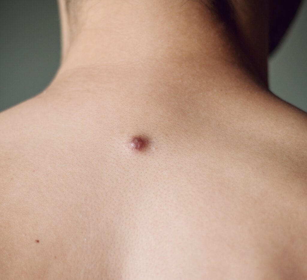 Kyste : causes et traitements | Dermatologie | Institut R.E.N | Gonesse